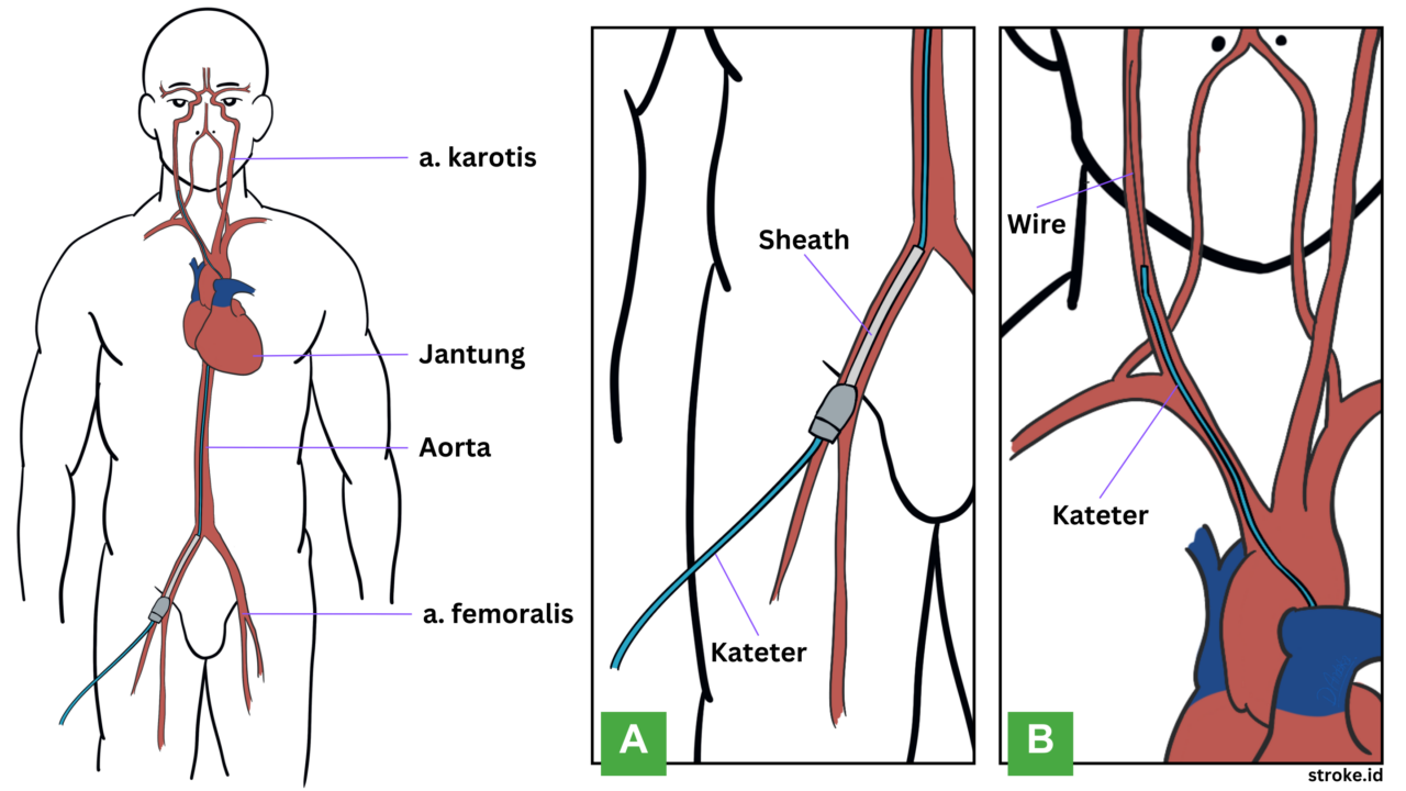 Cerebral Digital Subtraction Angiography (DSA) - Stroke.ID Cerebral Digital Subtraction Angiography (DSA) - Stroke.ID